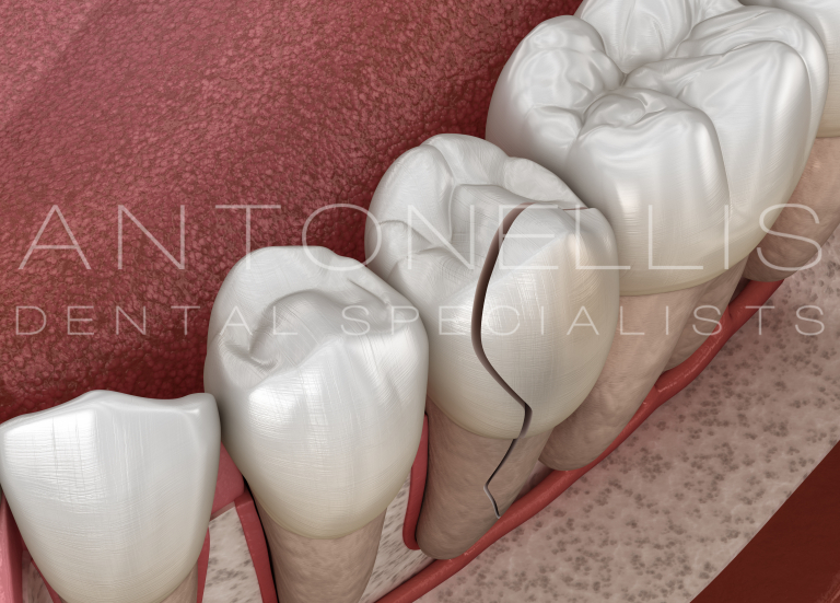 Blog | ANTONELLIS DENTAL SPECIALISTS