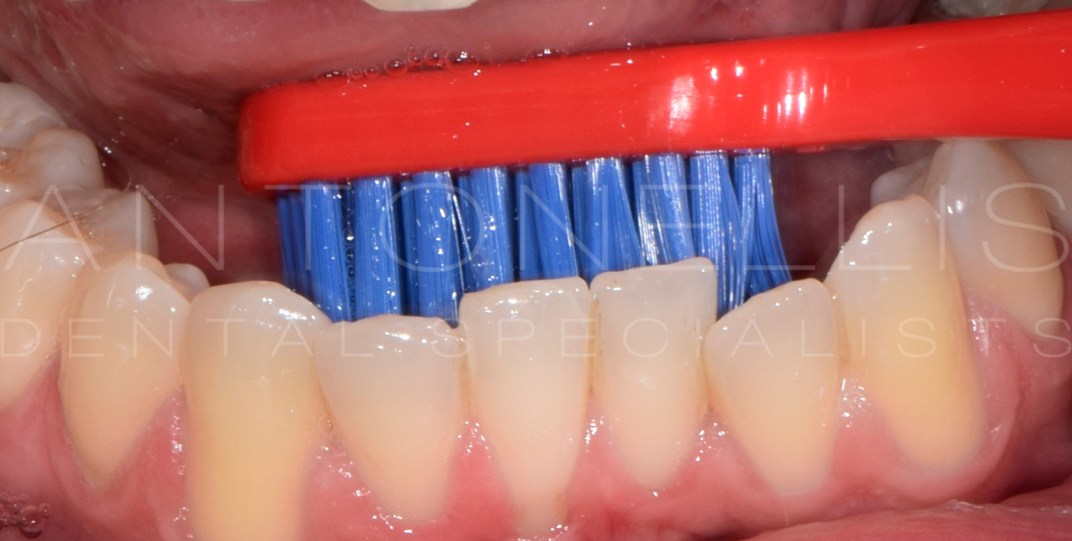 ΠΩΣ ΠΡΕΠΕΙ ΝΑ ΒΟΥΡΤΣΙΖΩ ΤΑ ΔΟΝΤΙΑ ΜΟΥ; - ΟΔΟΝΤΙΑΤΡΟΣ ΧΑΛΑΝΔΡΙ