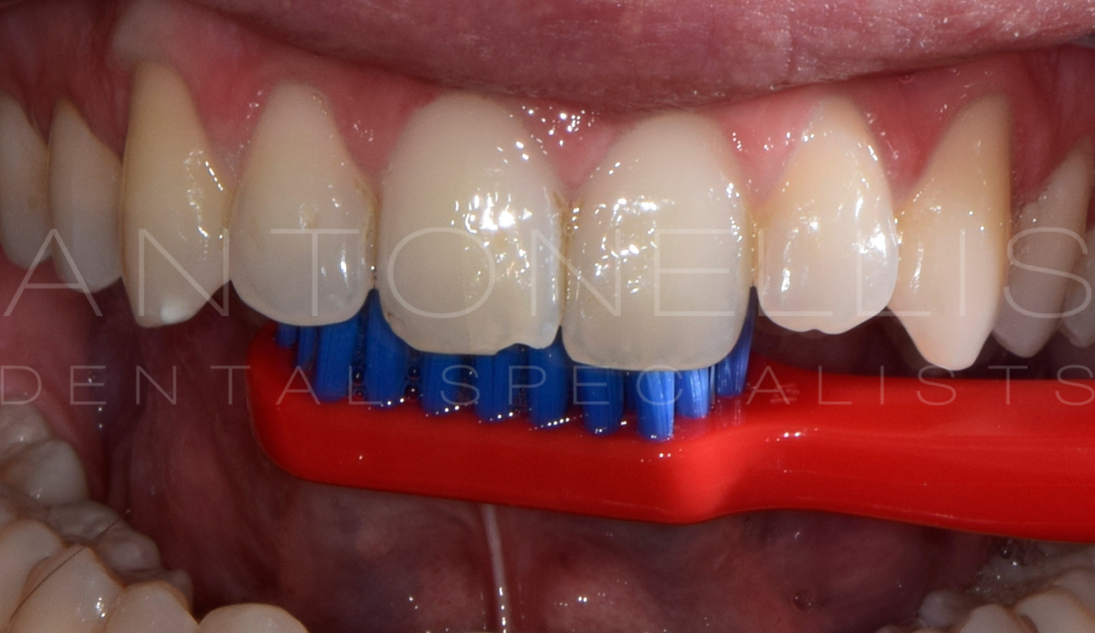 ΠΩΣ ΠΡΕΠΕΙ ΝΑ ΒΟΥΡΤΣΙΖΩ ΤΑ ΔΟΝΤΙΑ ΜΟΥ; - ΟΔΟΝΤΙΑΤΡΟΣ ΧΑΛΑΝΔΡΙ