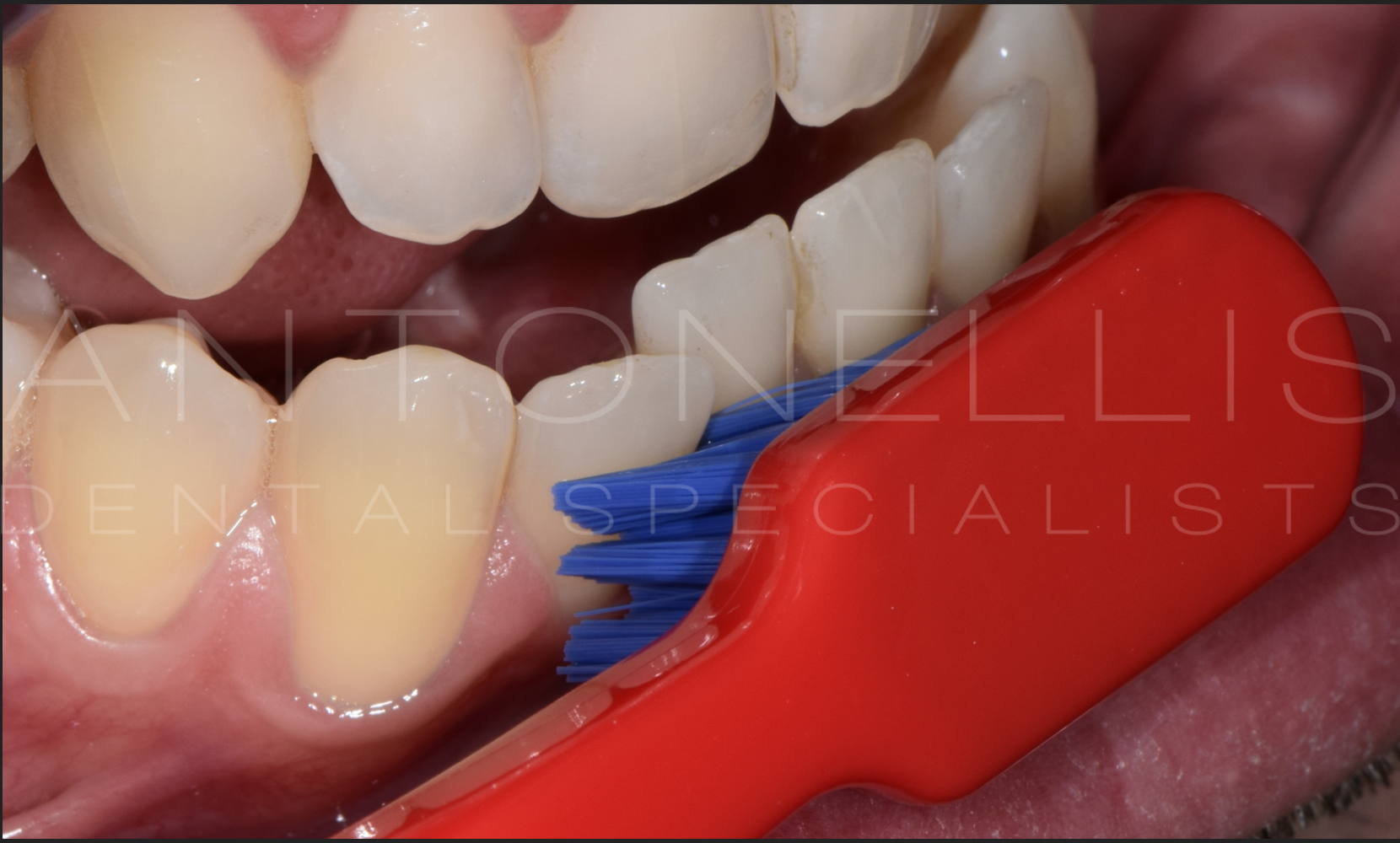 ΠΩΣ ΠΡΕΠΕΙ ΝΑ ΒΟΥΡΤΣΙΖΩ ΤΑ ΔΟΝΤΙΑ ΜΟΥ; - ΟΔΟΝΤΙΑΤΡΟΣ ΧΑΛΑΝΔΡΙ